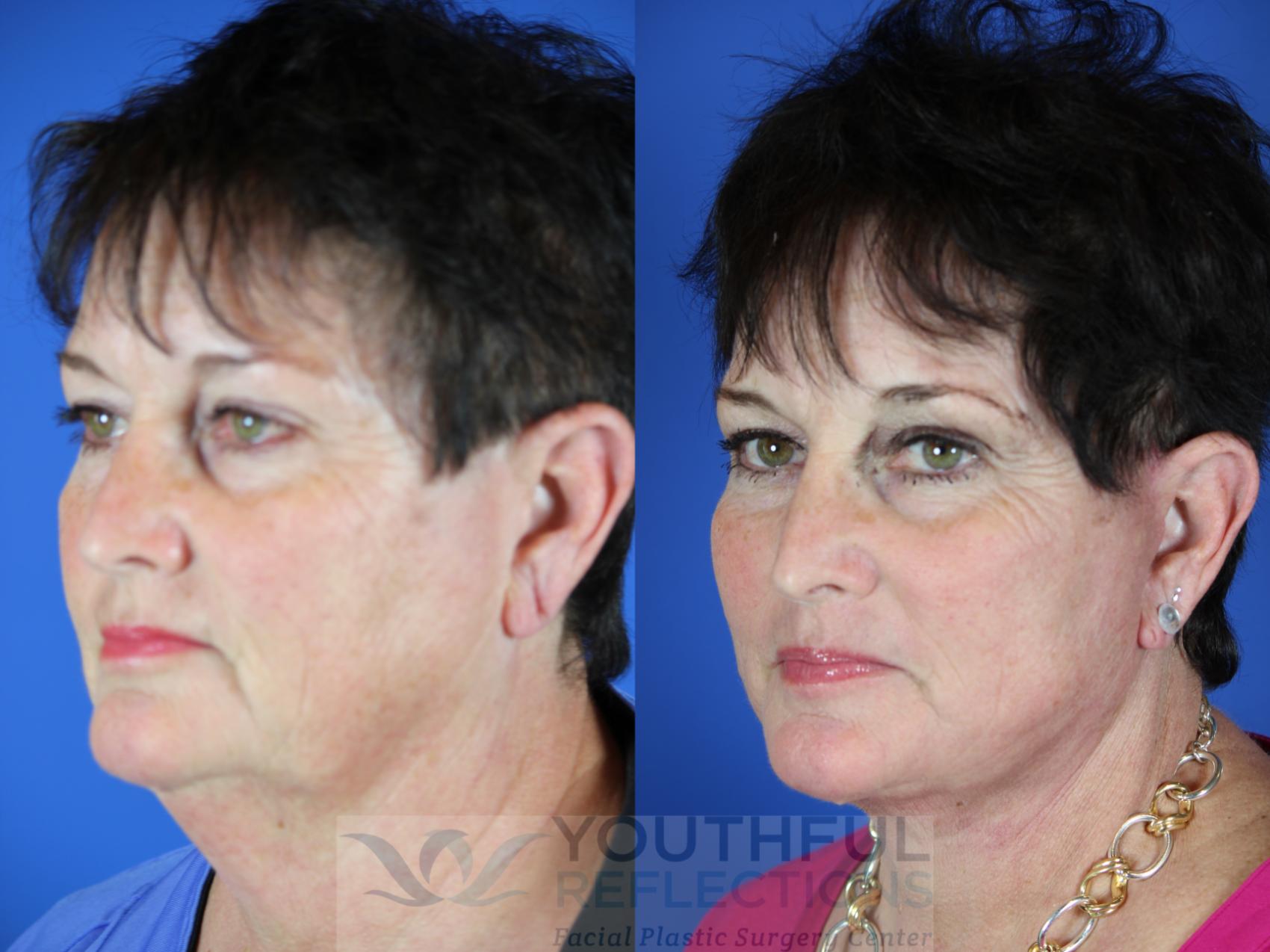 Facelift / Reflection Lift Before & After Photos Patient 11 | Nashville ...