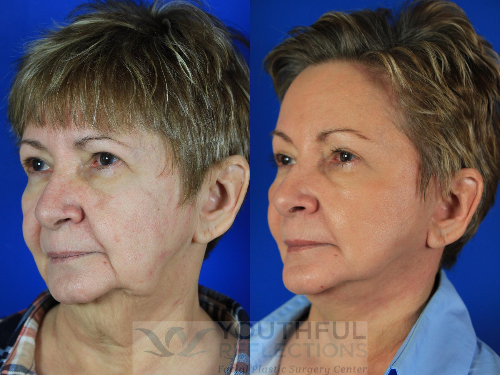 Facelift / Reflection Lift Before & After Photos Patient 128 | Nashville, TN | Youthful Reflections