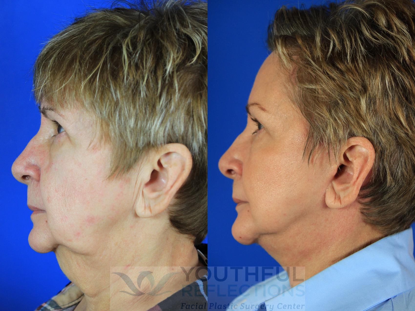 Facelift / Reflection Lift Before & After Photos Patient 128 ...