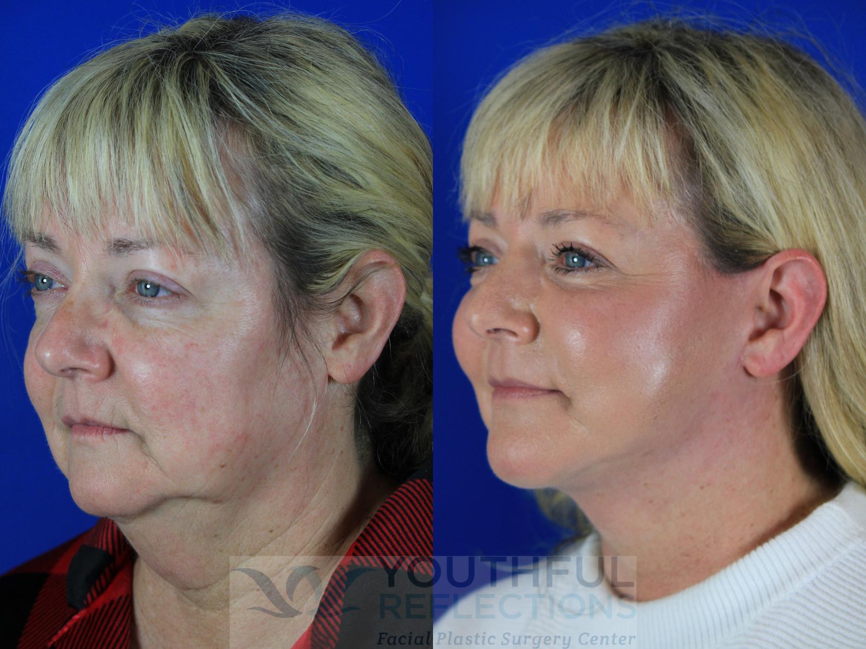 Facelift / Reflection Lift Before & After Photos Patient 129 | Nashville, TN | Youthful Reflections