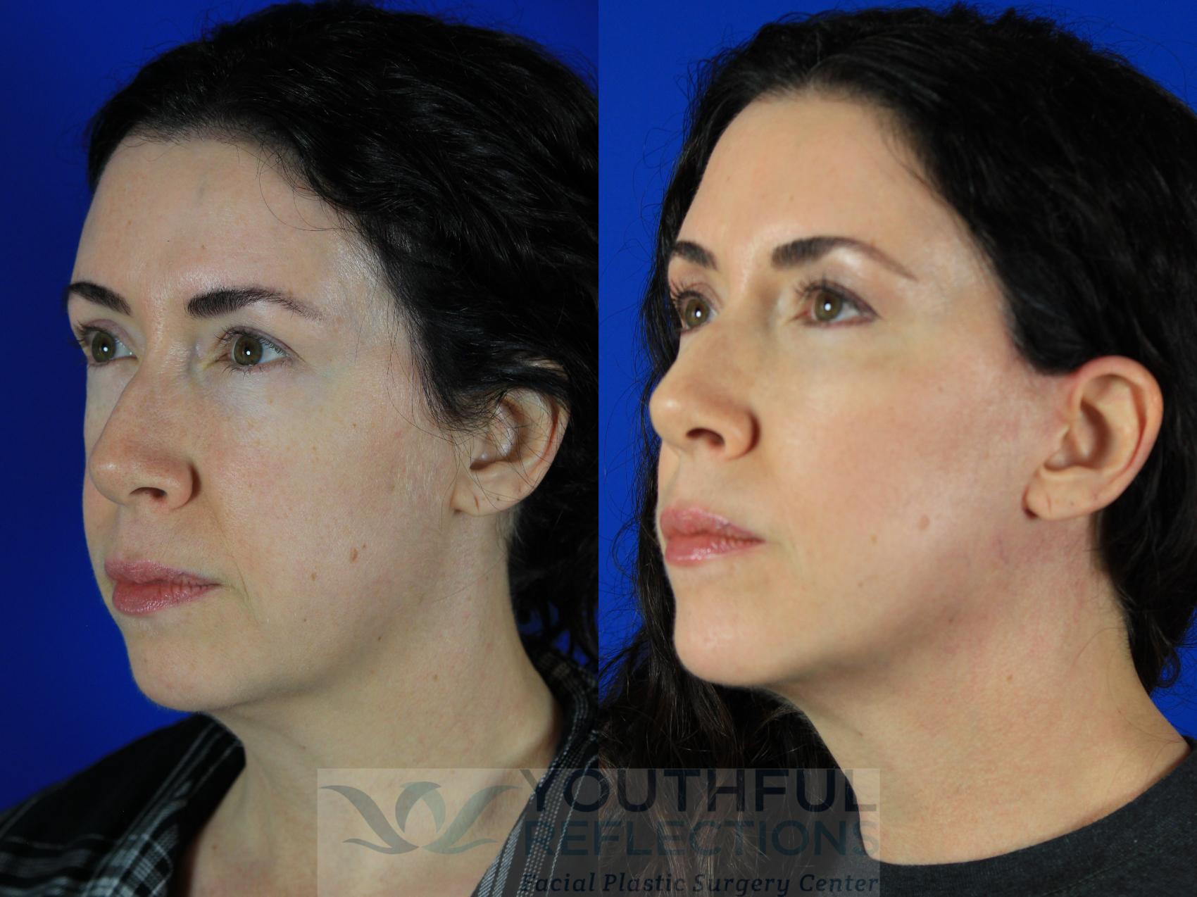Facelift / Reflection Lift Before & After Photos Patient 132 ...