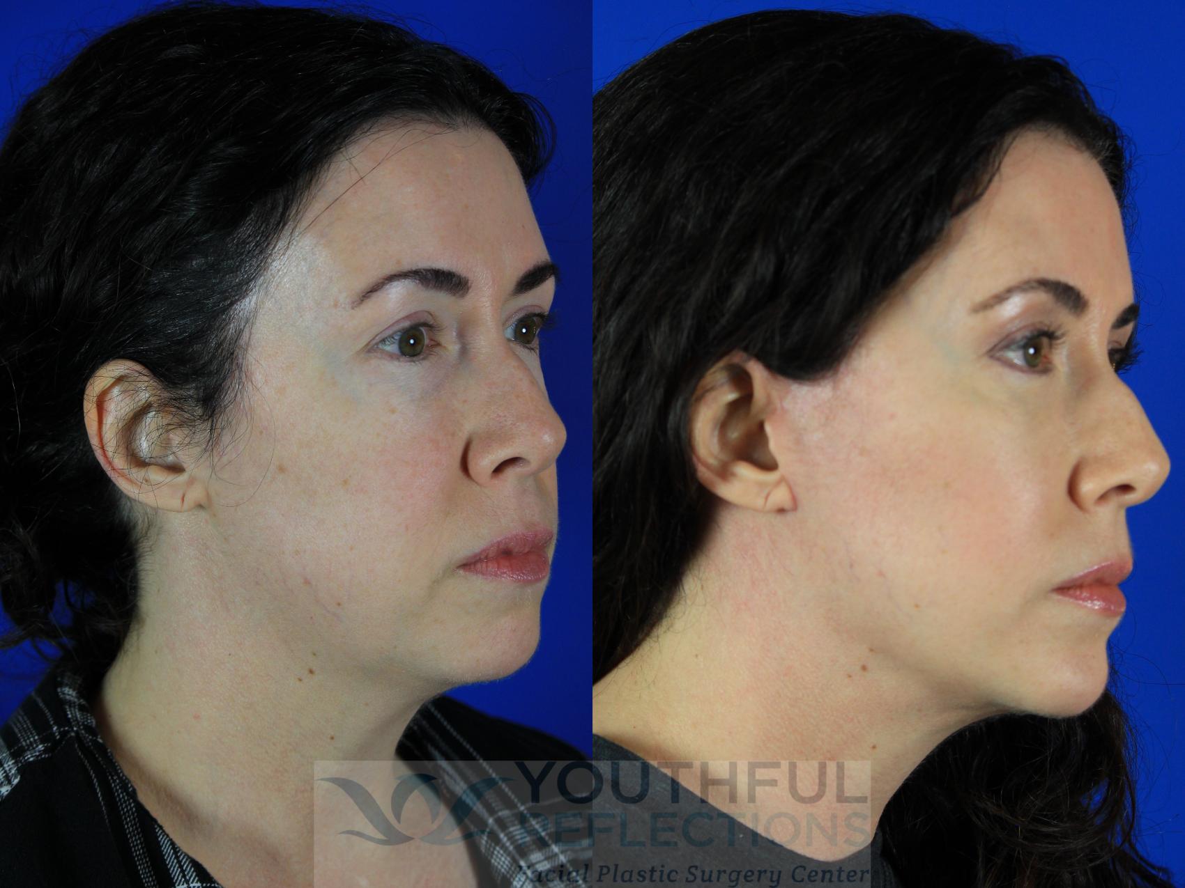 Facelift / Reflection Lift Before & After Photos Patient 132 ...