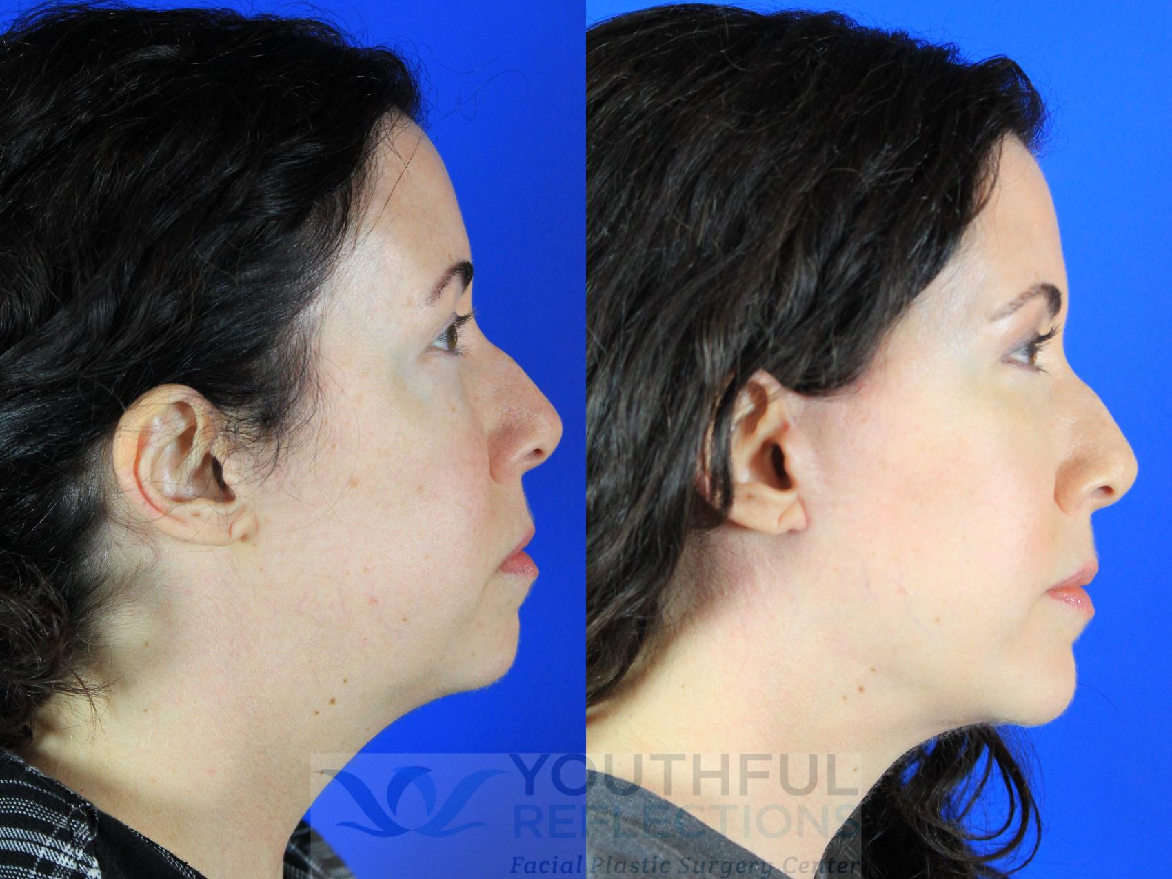 Facelift / Reflection Lift Before & After Photos Patient 132 ...