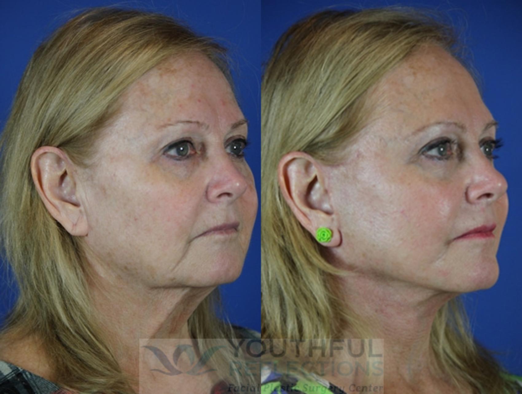 Facelift / Reflection Lift Before & After Photos Patient 39 | Nashville ...