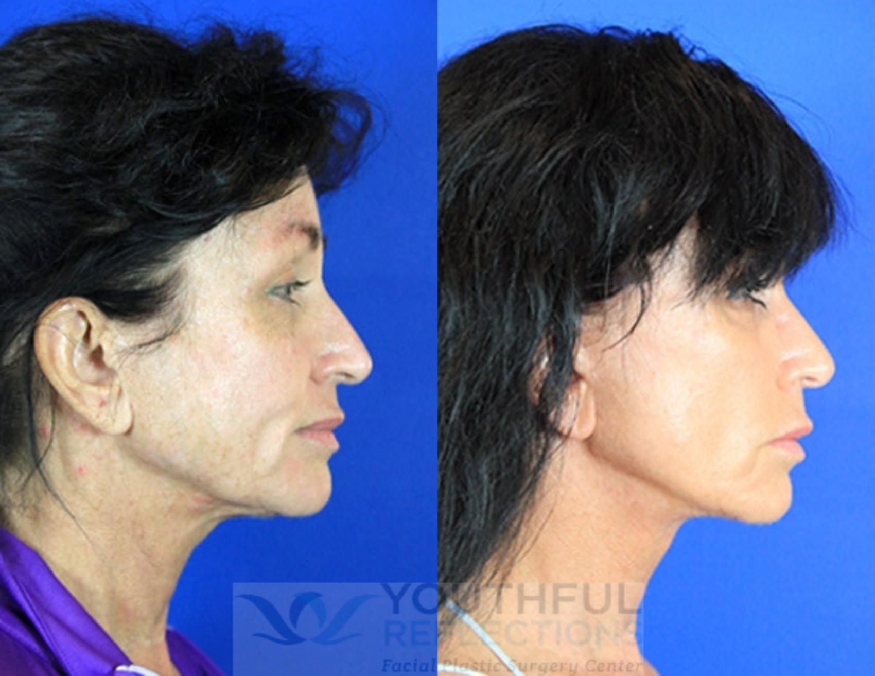 Facelift / Reflection Lift Before & After Photos Patient 83 | Nashville ...
